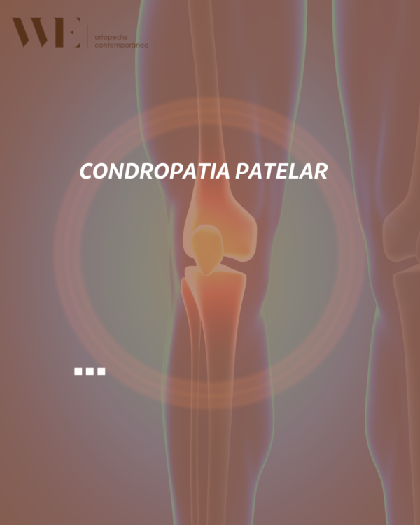 Condropatia Patelar – We